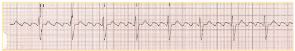 Topic - Atrial Flutter | Arrhythmia Interpretation Certification Course ...
