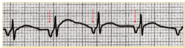 Topic - The Junctional Pacemaker | Arrhythmia Course | ACLS ...