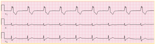 Topic - Idioventricular Rhythm | Arrhythmia Course | ACLS Certification ...