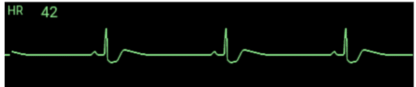 ACLS Megacode Scenario 3 | ACLS Simulator | ACLS Certification Association