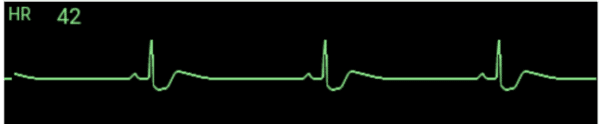 ACLS Megacode Scenario 3 | ACLS Simulator | ACLS Certification Association