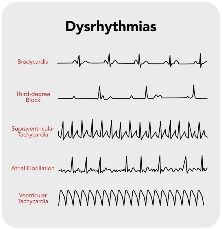 5 Common Dysrhythmias and Treatments | ACLS Certification Association