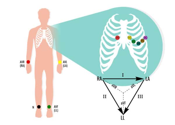 Topic - Monitoring the Leads | Arrhythmia Interpretation Certification ...