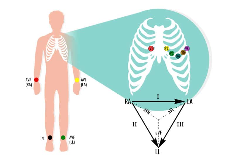 Topic - Monitoring the Leads | Arrhythmia Interpretation Certification ...