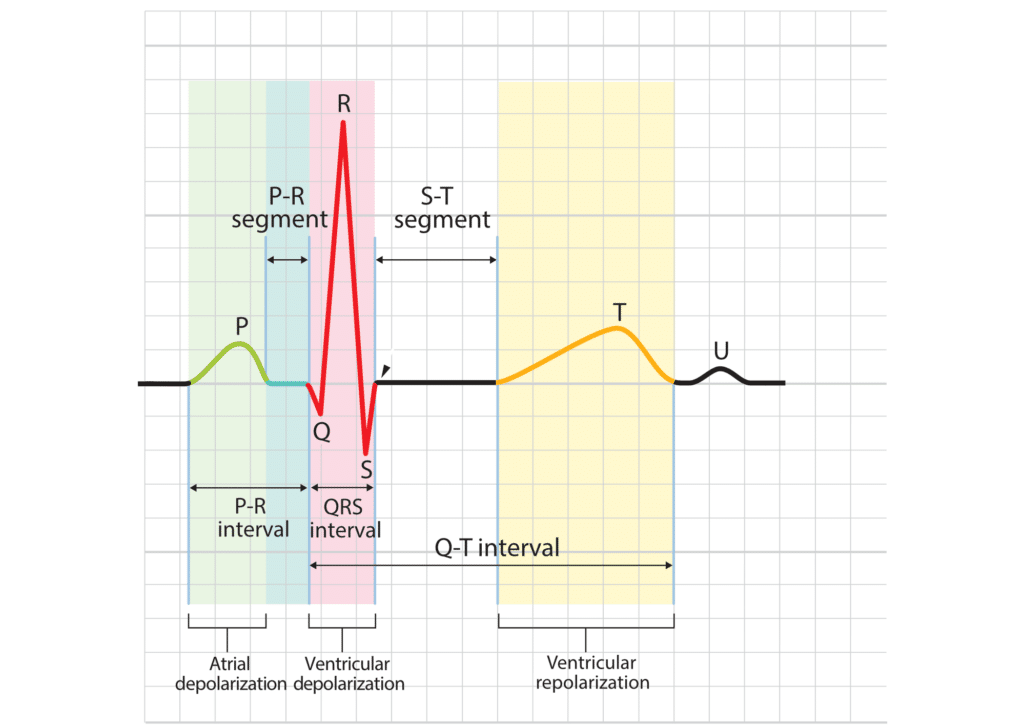 Topic - Waves, Complexes, Segments, and Intervals | Arrhythmia Course ...