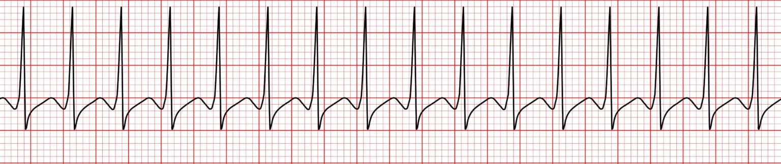 Topic - Supraventricular Tachycardia | Arrhythmia Interpretation ...