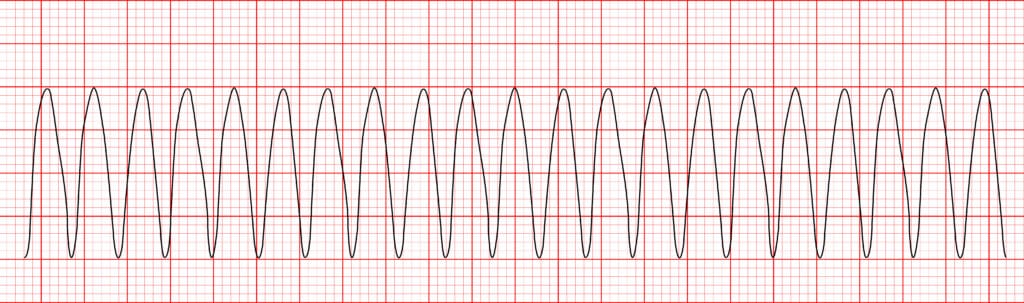Topic - Ventricular Tachycardia | Arrhythmia Interpretation ...