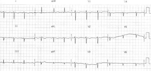 Congenital and Valvular Disease Flashcard | 12-Lead ECG Flashcards ...
