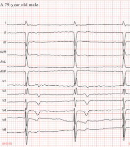 Cardiac Blocks Flashcard - 12-Lead ECG Flashcards - ACLS Certification ...