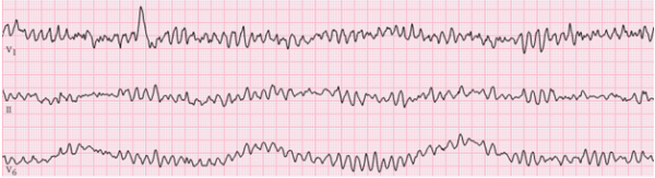Rhythm Strip Identification Flashcard 3 | Arrhythmia Interpretation ...
