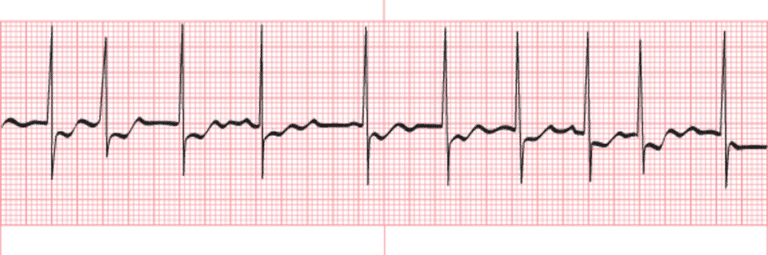 ECG Basic Principles Flashcard 1 | Arrhythmia Interpretation Flashcards ...