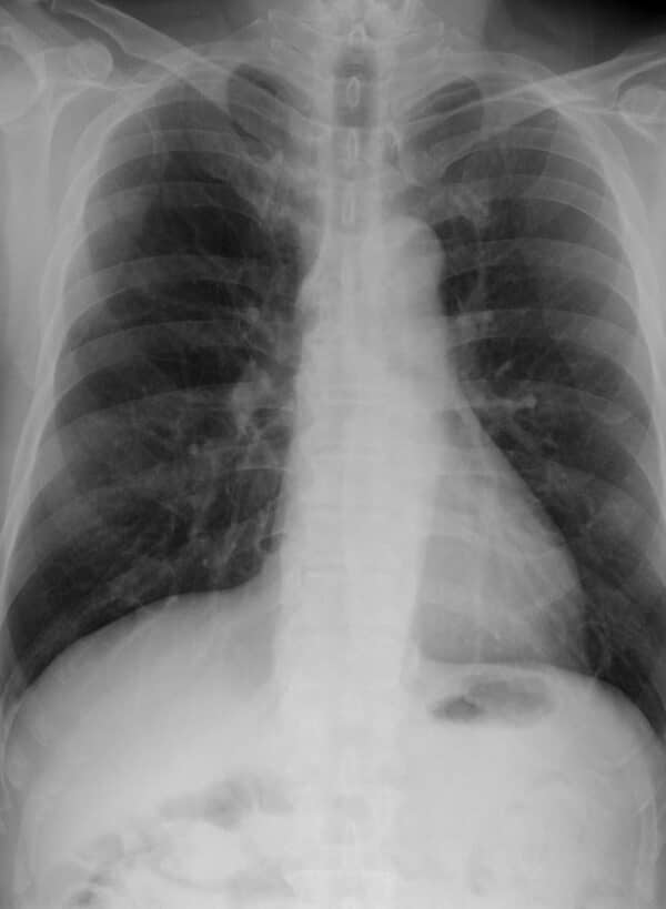 Basics of Ventilators: Part 2 | ACLS Certification Association