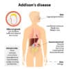 Addison Disease vs. Cushing Disease | ACLS Resources | ACLS Certification Association