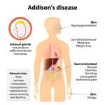 Addison Disease vs. Cushing Disease | ACLS Resources | ACLS Certification Association