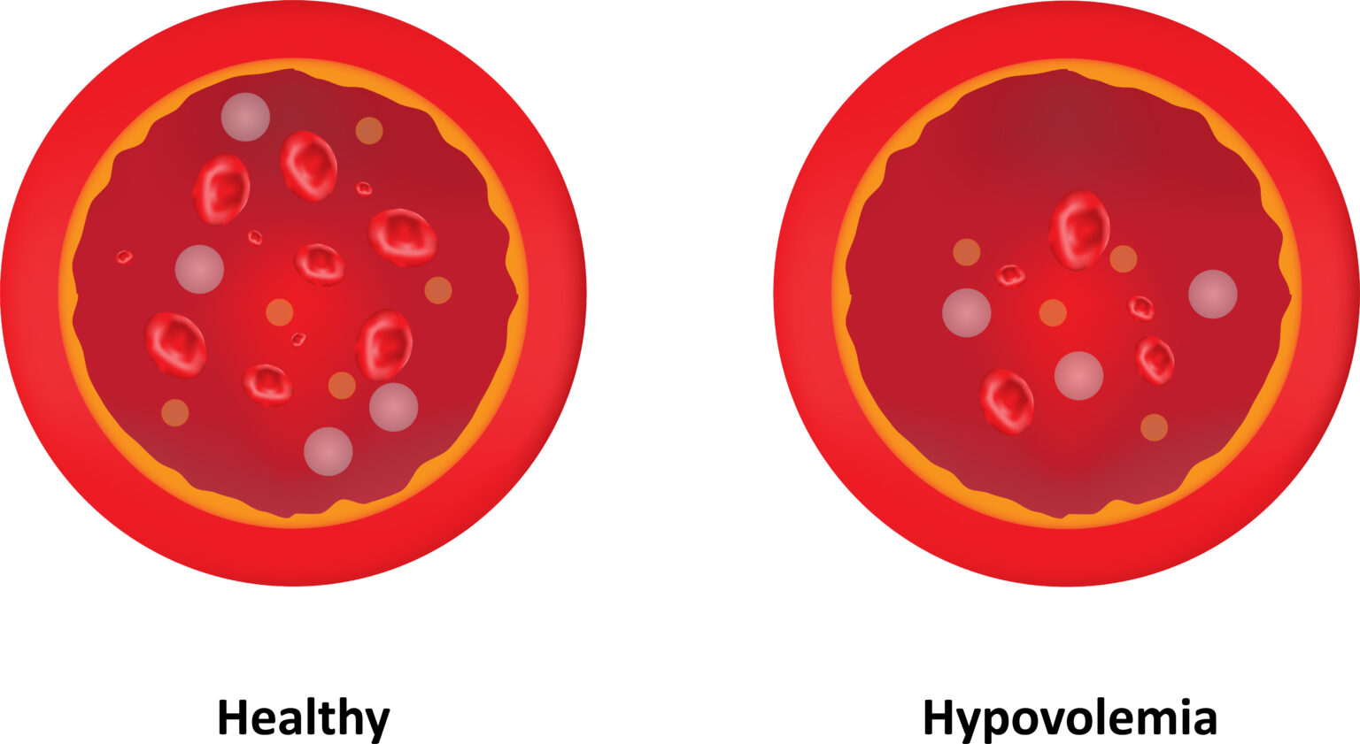 Shock Cardiogenic Hypovolemic And Septic Acls Certification Association