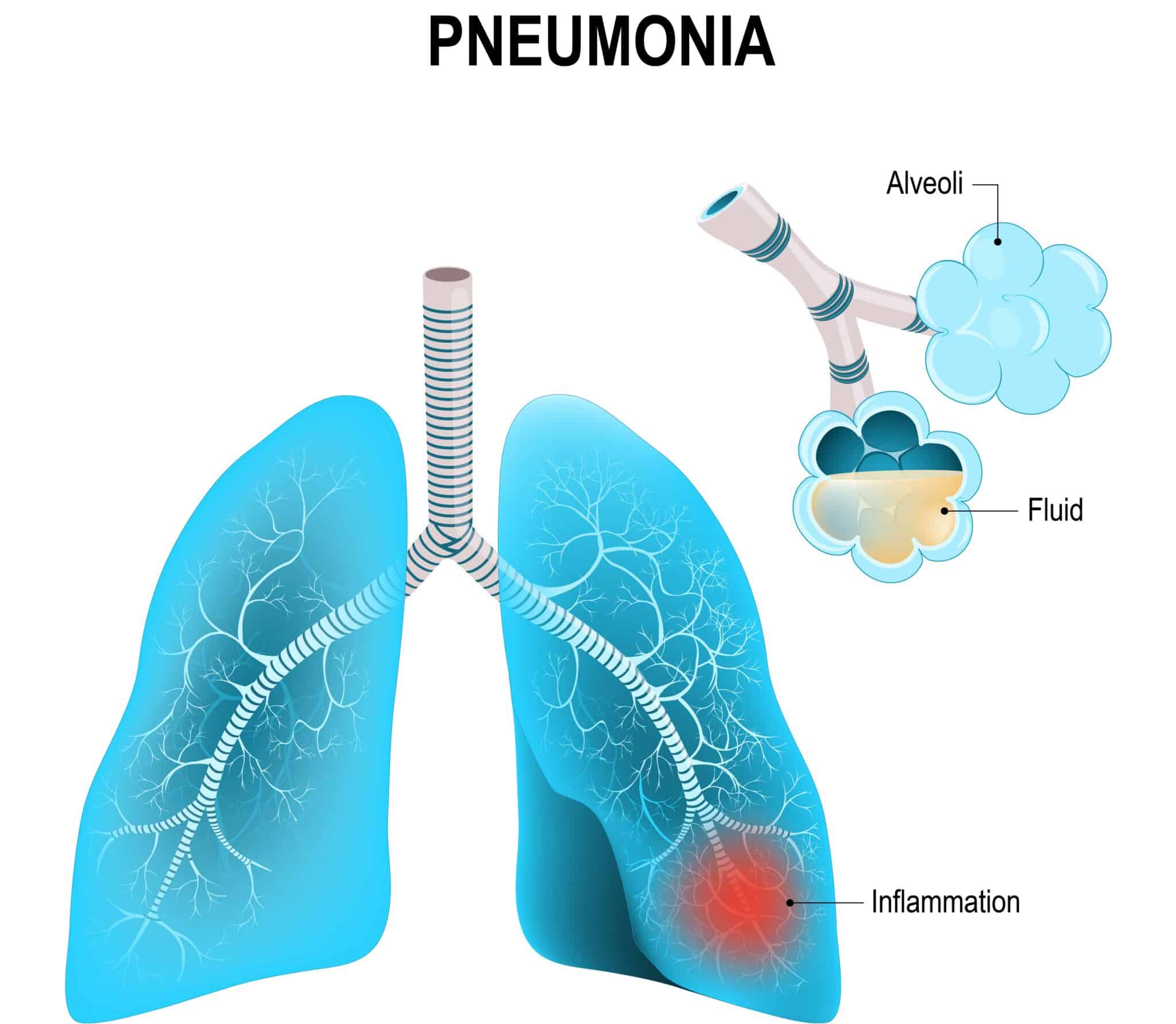 Three Common Types of Pneumonia | ACLS Resources | ACLS Certification ...