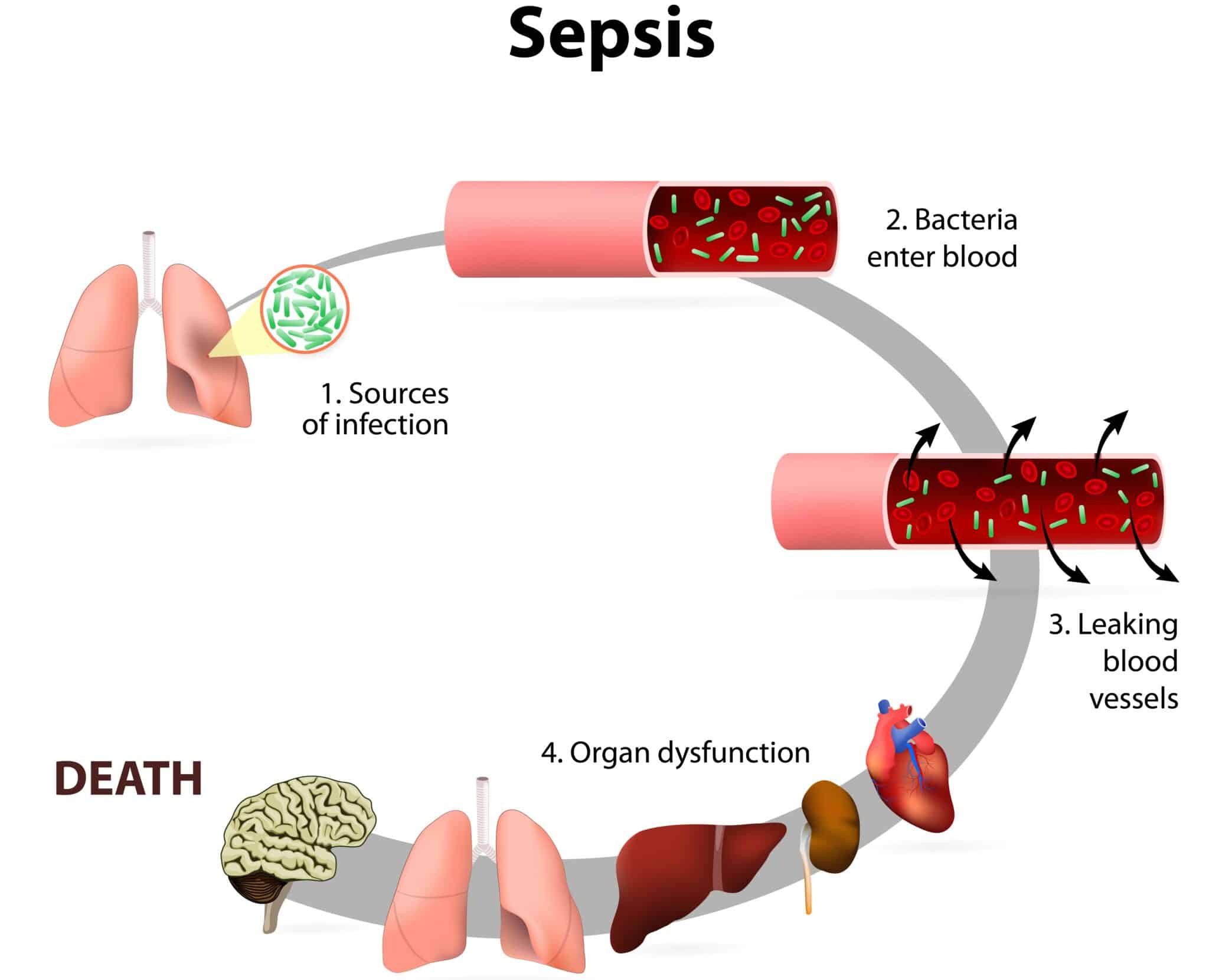 Shock: Cardiogenic, Hypovolemic, and Septic | ACLS Resources | ACLS ...