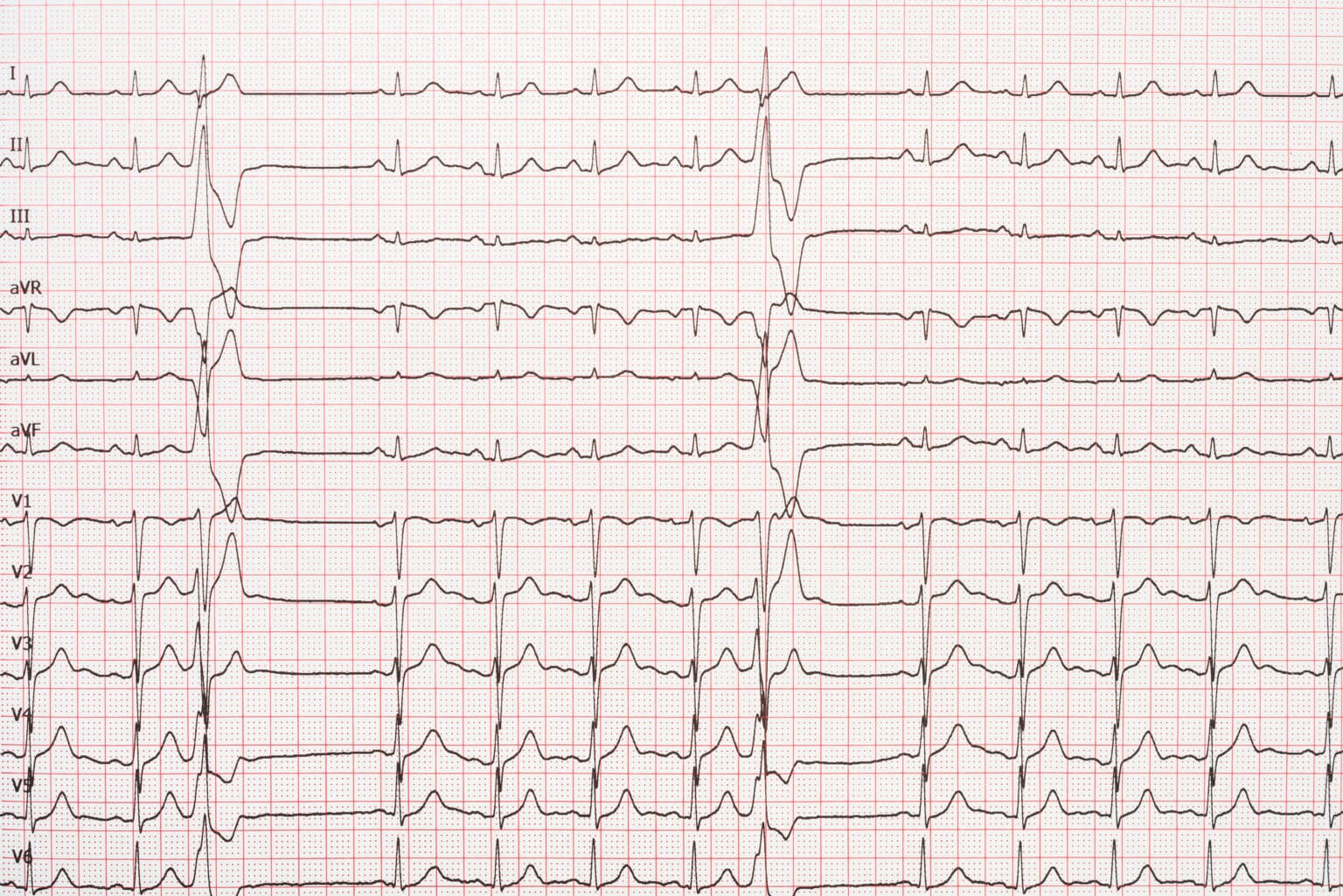 Acute Coronary Syndrome (ACS) Algorithm | ACLS Resources | ACLS ...