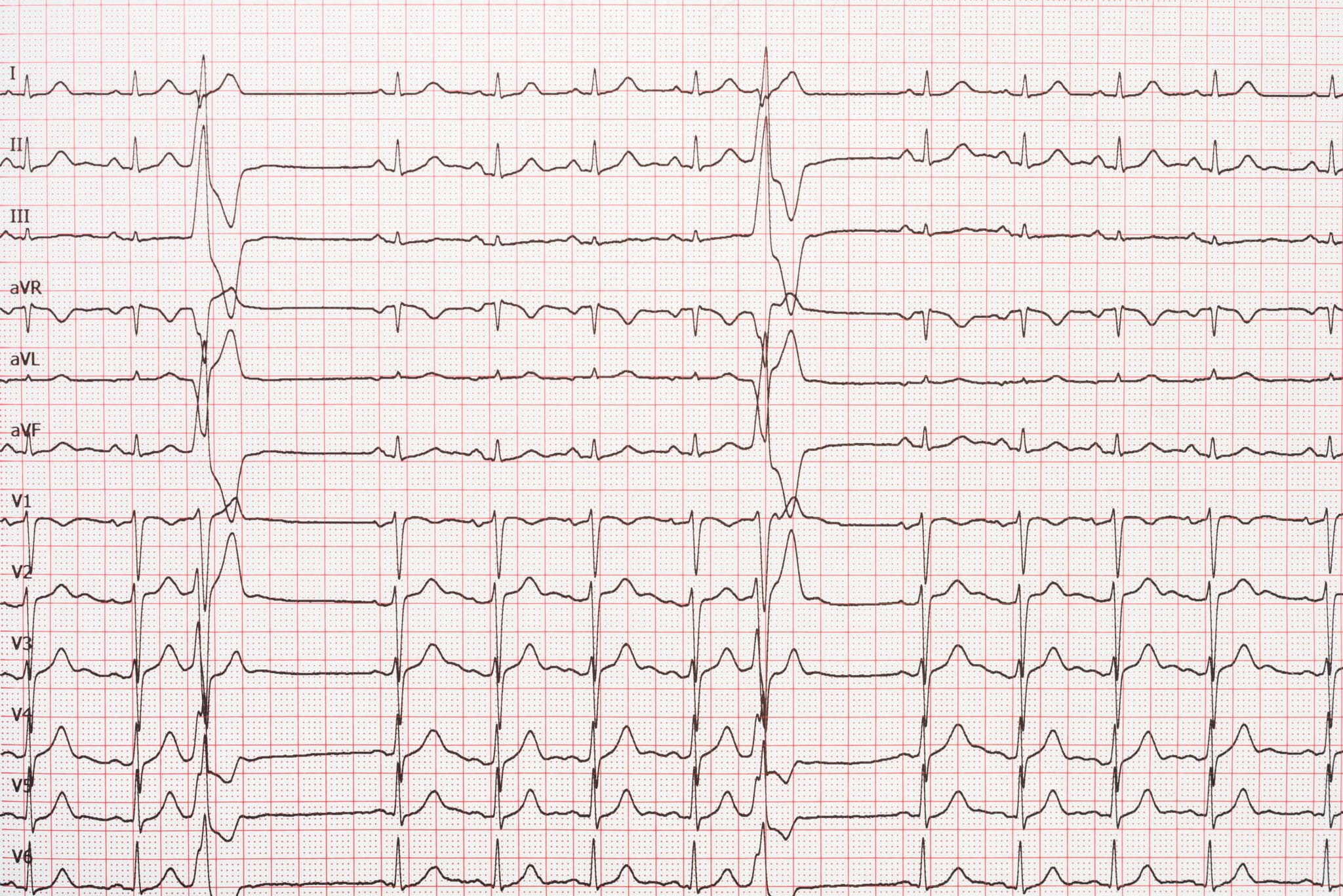 Acute Coronary Syndrome (ACS) Algorithm | ACLS Resources | ACLS ...