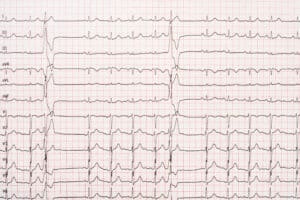 Acute Coronary Syndrome (ACS) Algorithm | ACLS Resources | ACLS ...