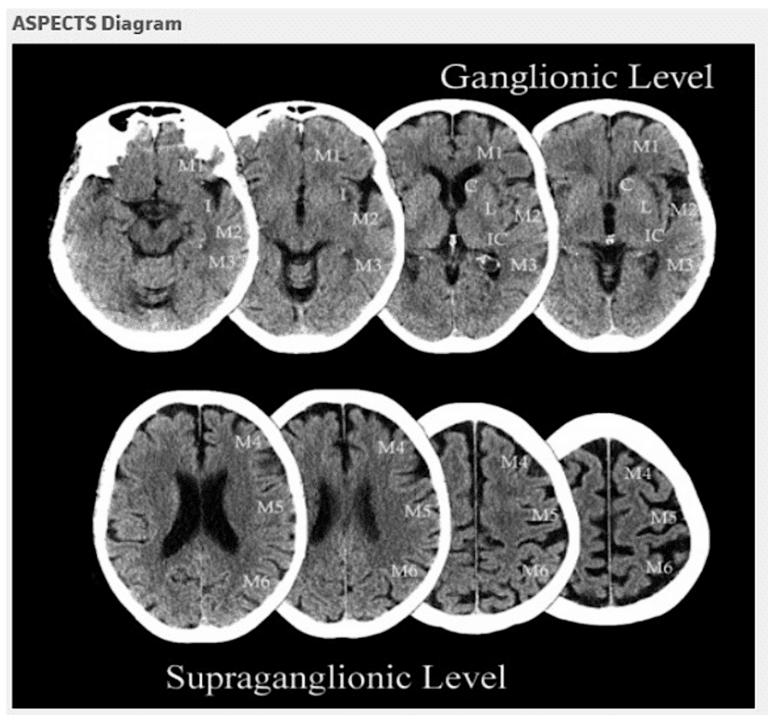 Fibrinolytic & Endovascular Therapies in Stroke | ACLS Resources | ACLS ...