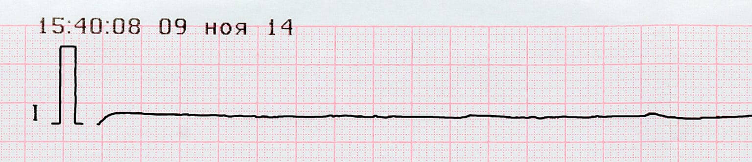 Ventricular Rhythms and Asystole | Arrhythmia Interpretation Resources ...