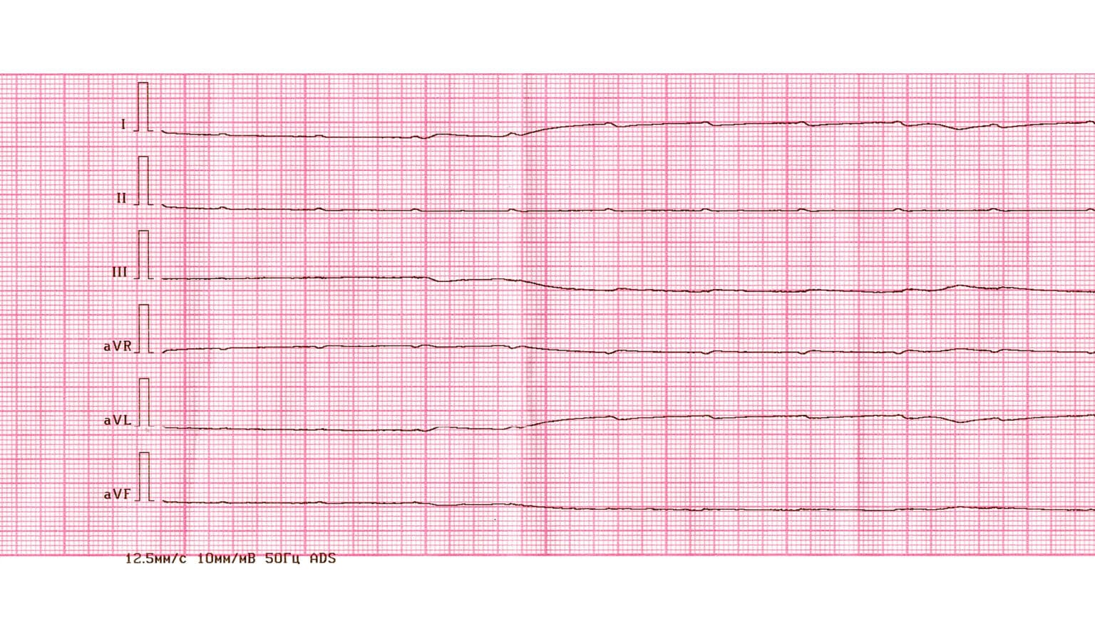Ultimate Guide to ACLS Algorithms: Cardiac Arrest | ACLS Resources ...