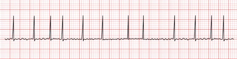 The Unstable Patient in Tachycardia | ACLS Resources | ACLS ...