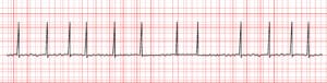 Rhythms Originating from the Atrium | 12-Lead ECG Resources | ACLS ...