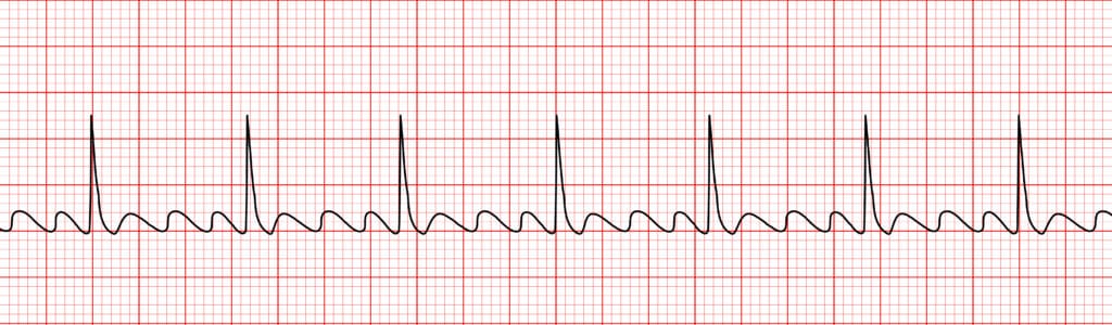 The Unstable Patient in Tachycardia | ACLS Resources | ACLS ...