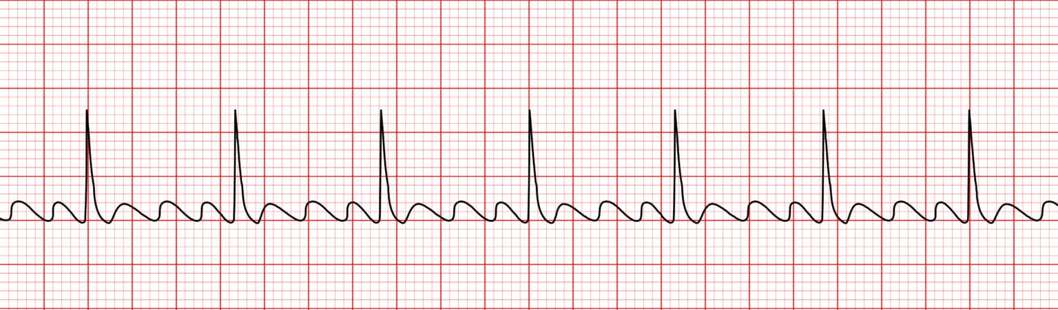 The Unstable Patient in Tachycardia | ACLS Resources | ACLS ...
