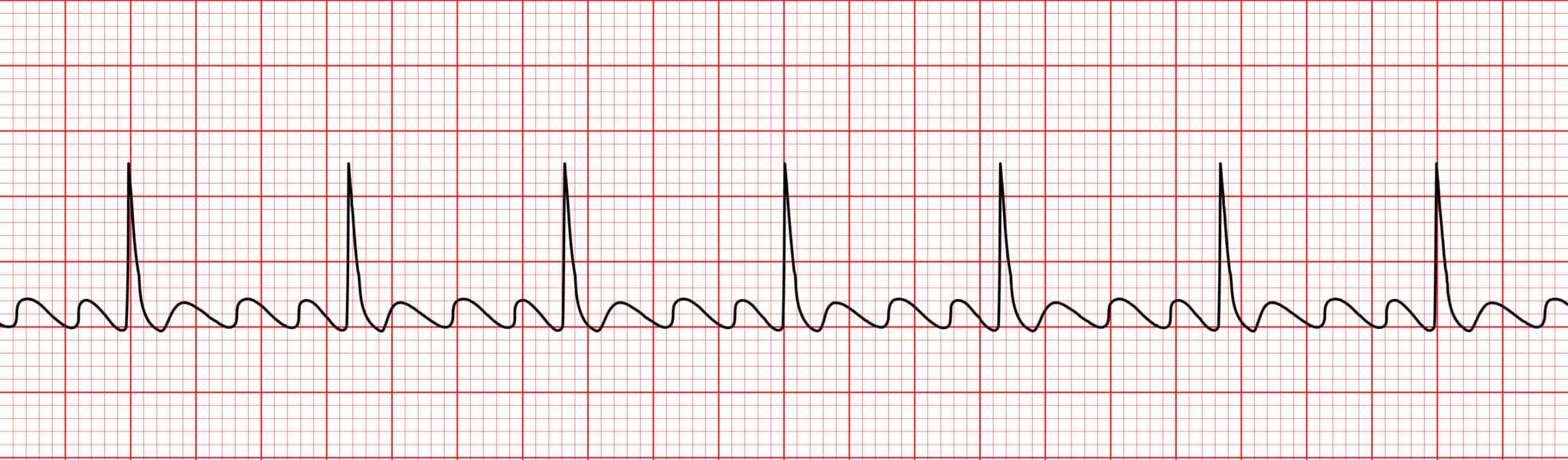 The Unstable Patient in Tachycardia | ACLS Resources | ACLS ...