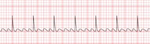 The Unstable Patient in Tachycardia | ACLS Resources | ACLS ...