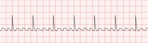 The Unstable Patient in Tachycardia | ACLS Resources | ACLS ...