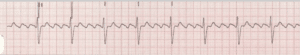 Rhythms Originating from the Atrium | 12-Lead ECG Resources | ACLS ...
