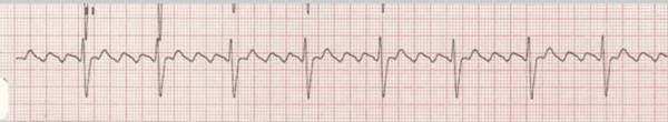 Rhythms Originating from the Atrium | 12-Lead ECG Resources | ACLS ...