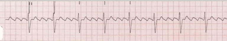 Rhythms Originating from the Atrium | 12-Lead ECG Resources | ACLS ...
