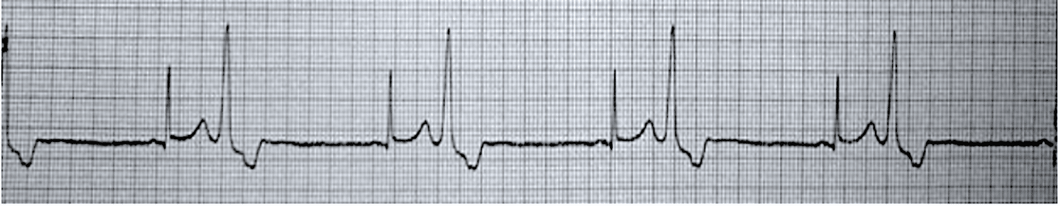 Ventricular Rhythms and Asystole | Arrhythmia Interpretation Resources ...