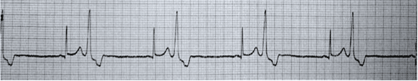 Ventricular Rhythms and Asystole | ACLS Certification Association