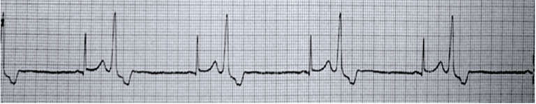 Ventricular Rhythms and Asystole | ACLS Certification Association