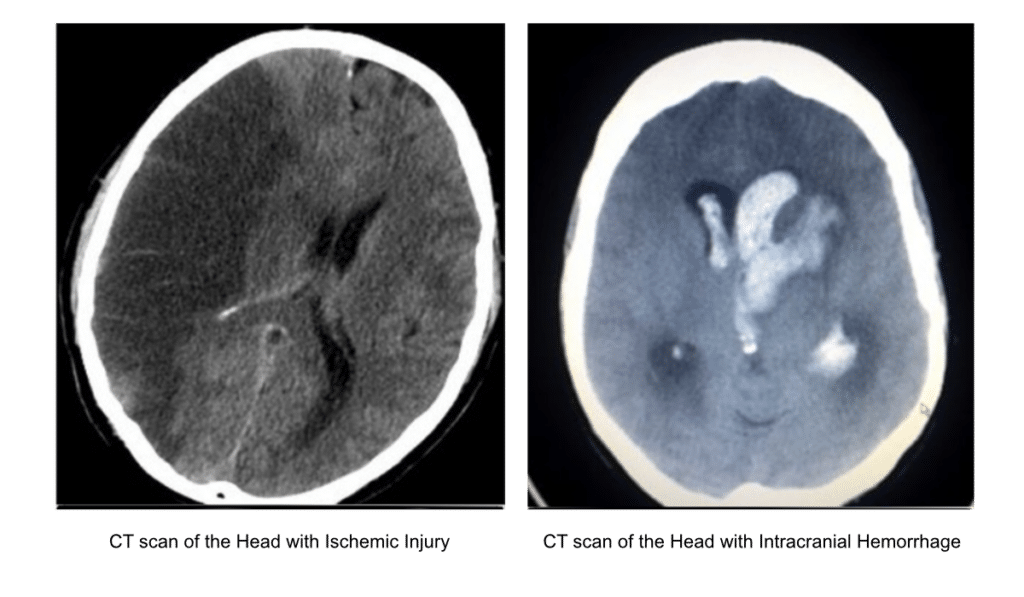 Stroke Assessment in the ED | ACLS Resources | ACLS Certification Association