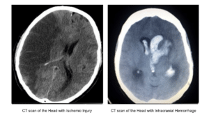 Stroke Assessment in the ED | ACLS Resources | ACLS Certification ...