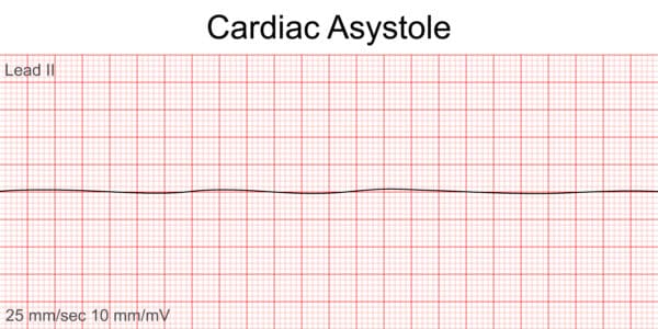 ACLS Asystole and PEA Algorithm | ACLS Resources | ACLS Certification ...