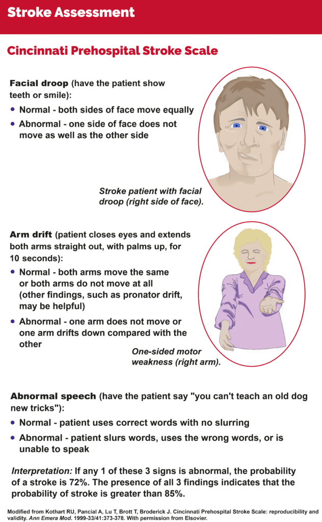 Stroke: Assessment and Important Time Frames Outside of the Hospital ...