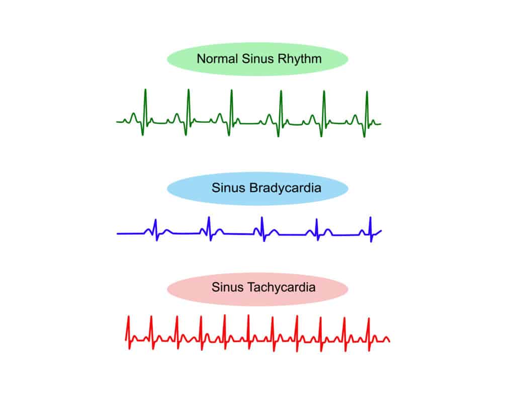 Normal Sinus Rhythm, Sinus Bradycardia, Tachycardia & Arrhythmias | 12 ...