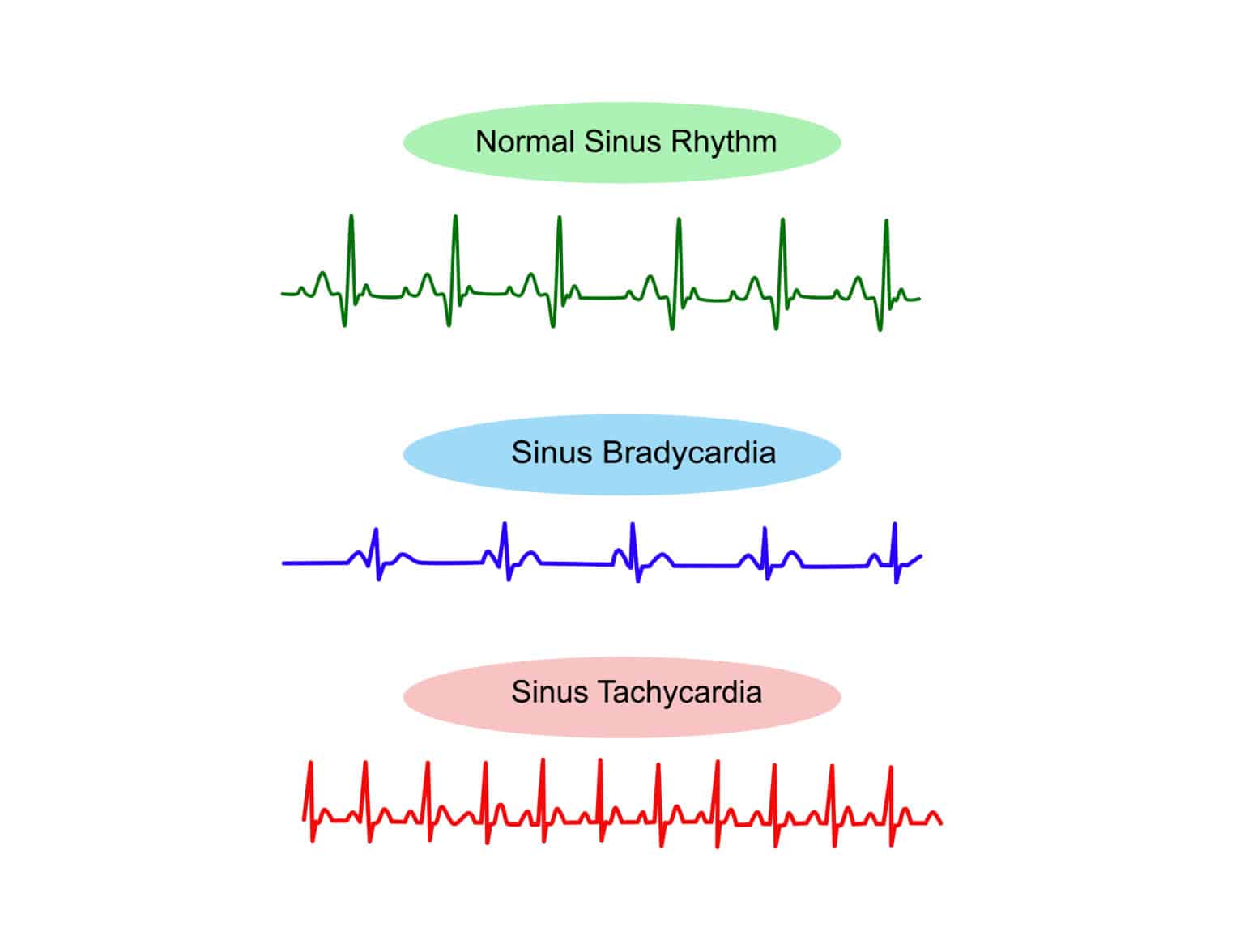 Normal Sinus Rhythm, Sinus Bradycardia, Tachycardia & Arrhythmias | 12 ...
