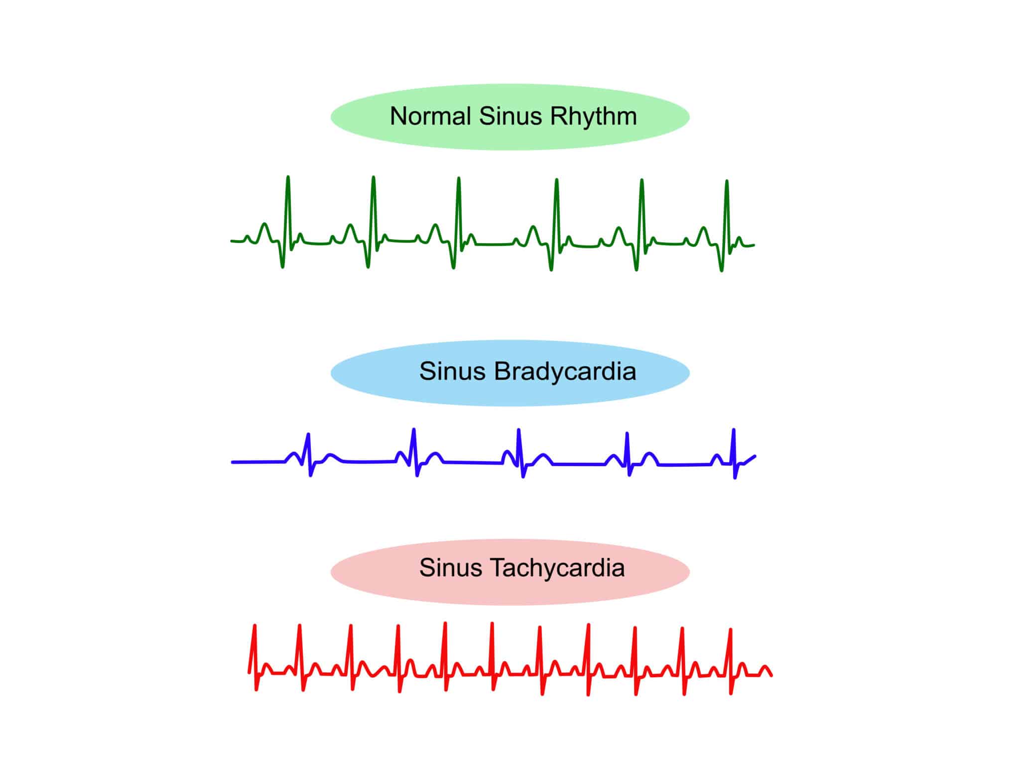 Normal Sinus Rhythm, Sinus Bradycardia, Tachycardia & Arrhythmias | 12 ...