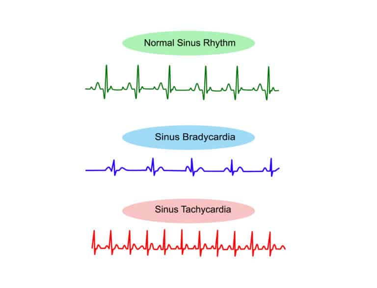Normal Sinus Rhythm, Sinus Bradycardia, Tachycardia & Arrhythmias | 12 ...