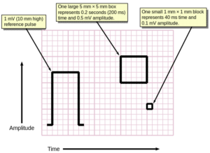 EKG & ECG Interpretation Explained | ACLS Certification Association