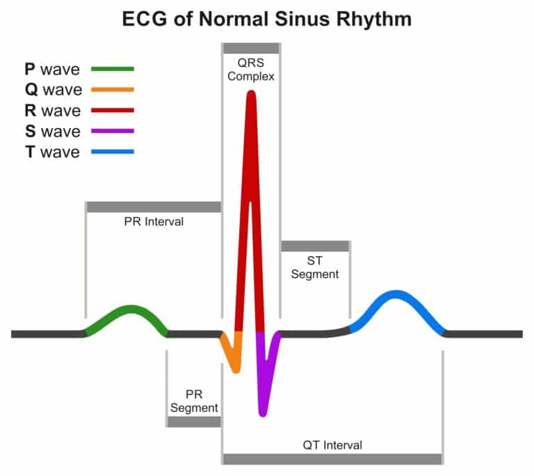 EKG & ECG Interpretation Explained | 12-Lead ECG Resources | ACLS ...